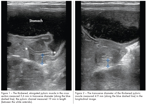 What is the cause of this infant's projectile vomiting? | Consultant360