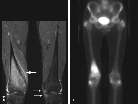 Chronic Recurrent Multifocal Osteomyelitis | Consultant360