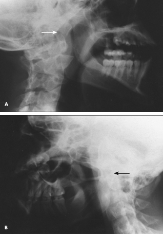 Four Cases of Bone Disorders | Consultant360