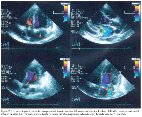 Pericardial Effusion With Heart Failure: Initial Sign of SLE in a ...