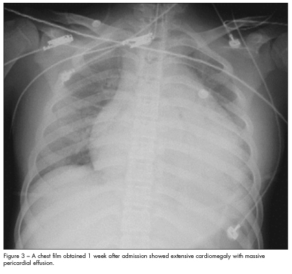 Pericardial Effusion With Heart Failure: Initial Sign of SLE in a ...