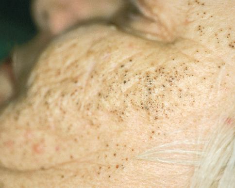 Clinical Consequences of Sun Exposure | Consultant360