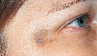 Clinical Consequences of Sun Exposure | Consultant360