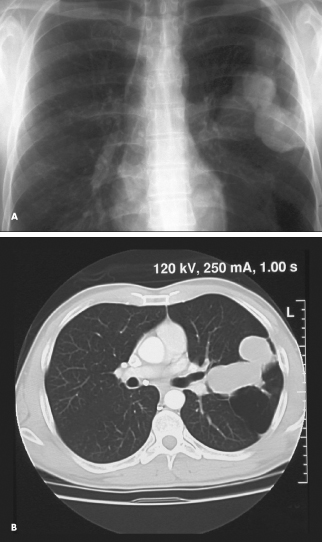 Bronchocele | Consultant360
