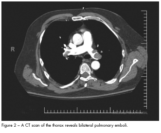 Thrombolytics in Acute Pulmonary Embolism Complicated by Refractory ...