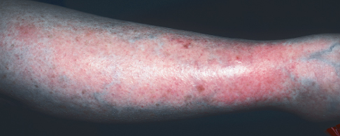 Is a drug reaction the cause of this patient’s pruritus? | Consultant360