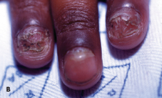 Cutaneous Manifestations of HIV Infection in Children Part 1: Infection ...