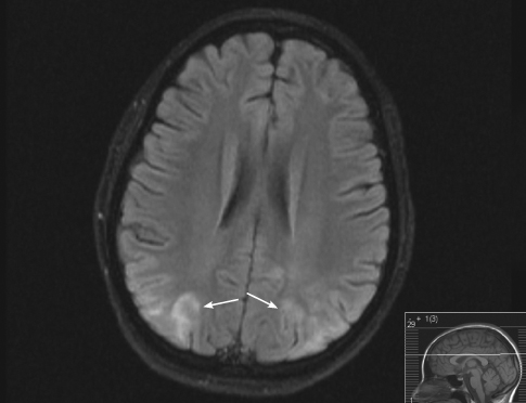 Posterior Reversible Encephalopathy Syndrome Radiology 461 Posterior
