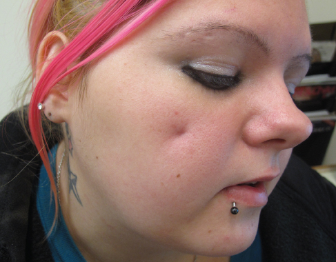 Young Woman With a Dimpled Lesion on Her Cheek | Consultant360