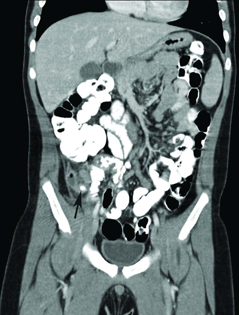 A Boy With Right Lower Quadrant Pain: What’s the Cause? | Consultant360