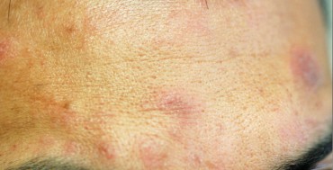 Does this facial eruption signal an underlying condition? | Consultant360