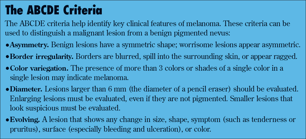 Moles and Melanoma | Consultant360