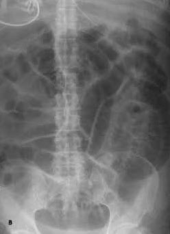 Trichotillomania | Consultant360