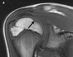 Osteochondral Fracture in a Baseball Player | Consultant360