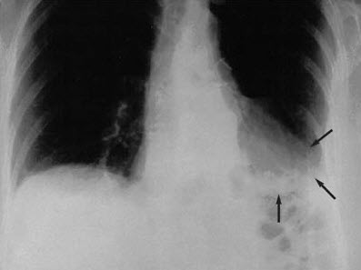 Woman With Cough and Dyspnea | Consultant360