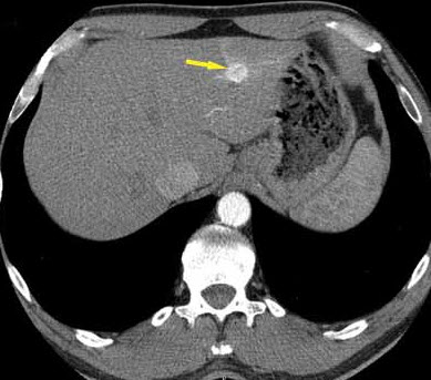 Man With Abdominal Bruit of Unusual Origin | Consultant360