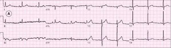 Discordant ECG Findings in a Man With Chest Pain | Consultant360