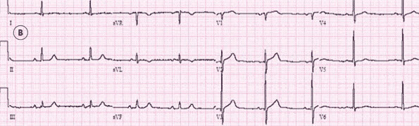 Discordant ECG Findings in a Man With Chest Pain | Consultant360