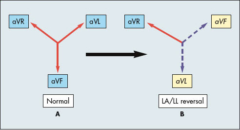 Discordant ECG Findings in a Man With Chest Pain | Consultant360