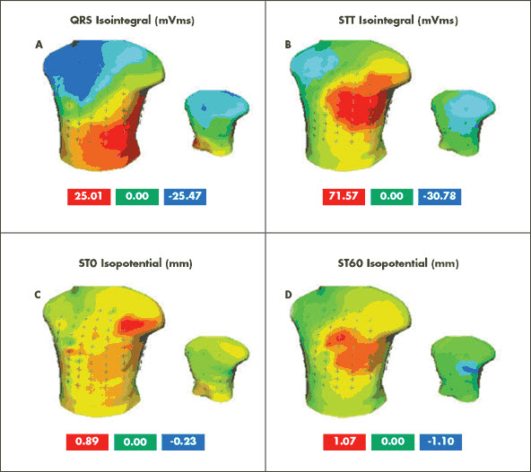 Taking Cardiac Imaging to New Dimensions: Body Surface Mapping ...