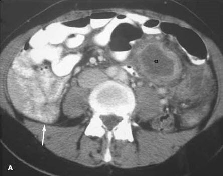 Appendicitis With Bowel Malrotation | Consultant360