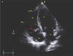Right-Sided Infective Endocarditis | Consultant360