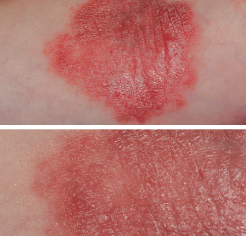 What could be responsible for this upper extremity rash? | Consultant360