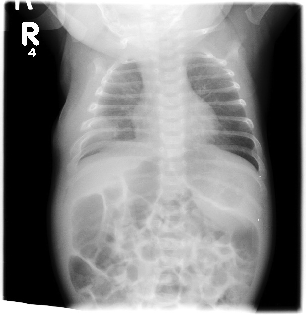 Photoclinic: MRSA Skin Abscess and Osteomyelitis | Consultant360