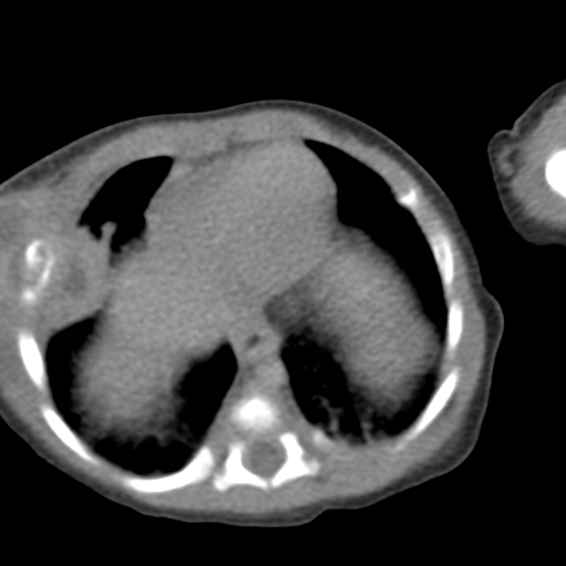 Photoclinic: MRSA Skin Abscess and Osteomyelitis | Consultant360