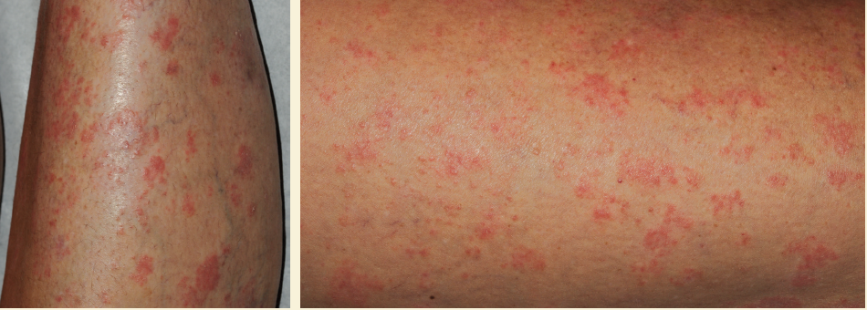 What is the cause of this patient’s psoriasis flare? | Consultant360