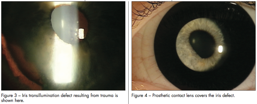 Traumatic Iridodialysis From an Airsoft Pellet in an Aviator ...