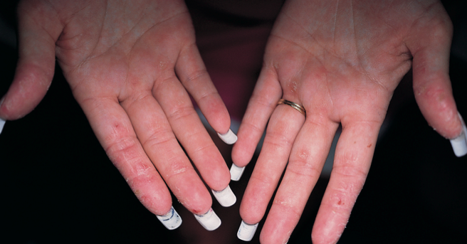 Which clues point to the cause of this pruritic rash? | Consultant360