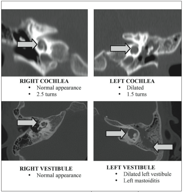 Bacterial Meningitis in Children: Could It Be Mondini Dysplasia ...