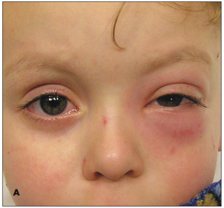 Subperiosteal Abscess | Consultant360