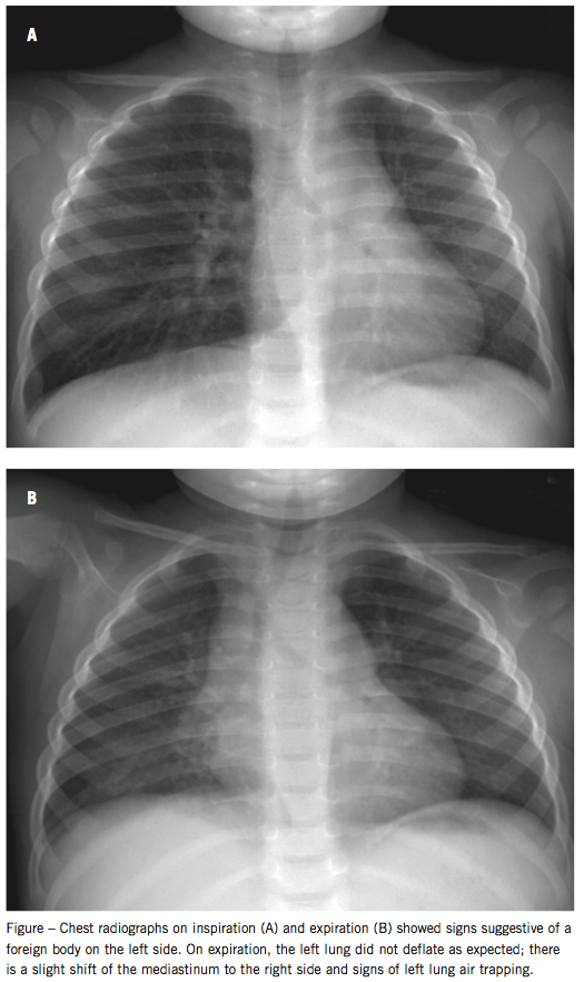MAC Infection Presenting as Foreign Body in Immunocompetent Toddler ...