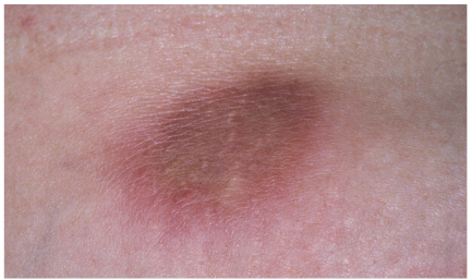 Mucocutaneous Drug Reactions | Consultant360