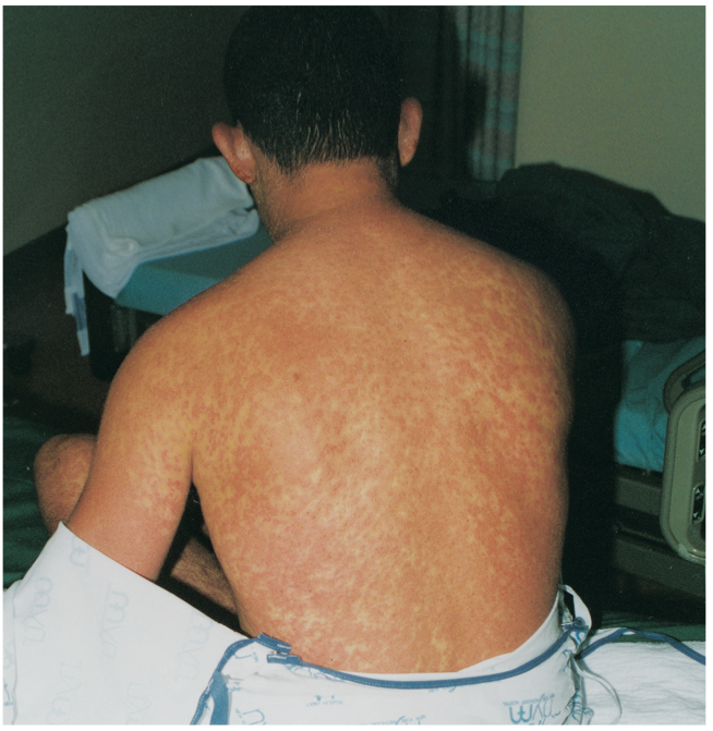 Mucocutaneous Drug Reactions | Consultant360