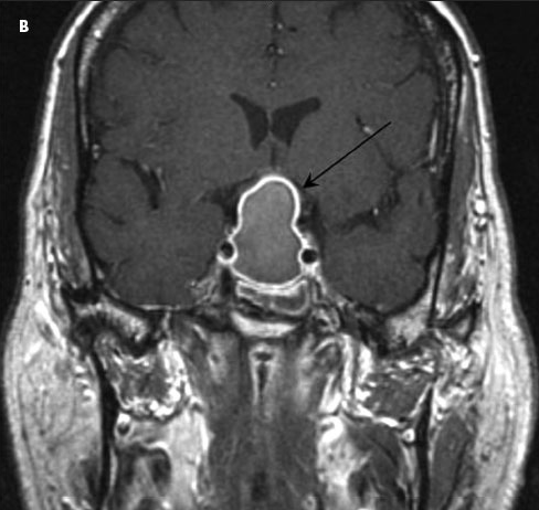 Apoplexy Christina's Story: Pituitary Apoplexy Pituitary Foundation