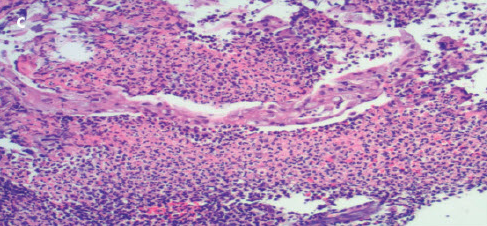 Apple Core Lesion | Consultant360