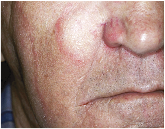 Man With Refractory Rash | Consultant360