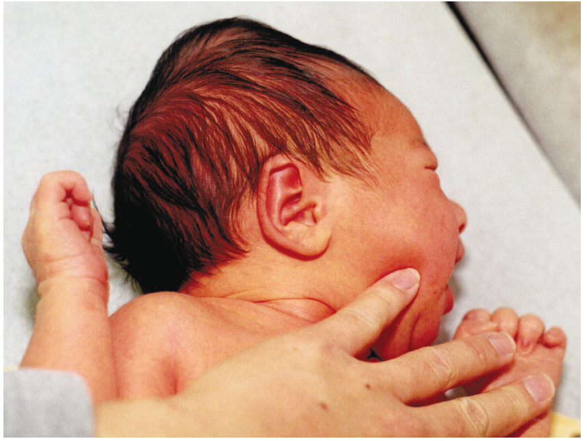Movable Lump On Back Of Child s Head Candelaria Bruns