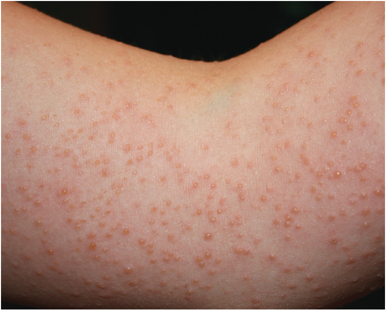 Itchy Bumps On Arms Itchy Bumps On Arms