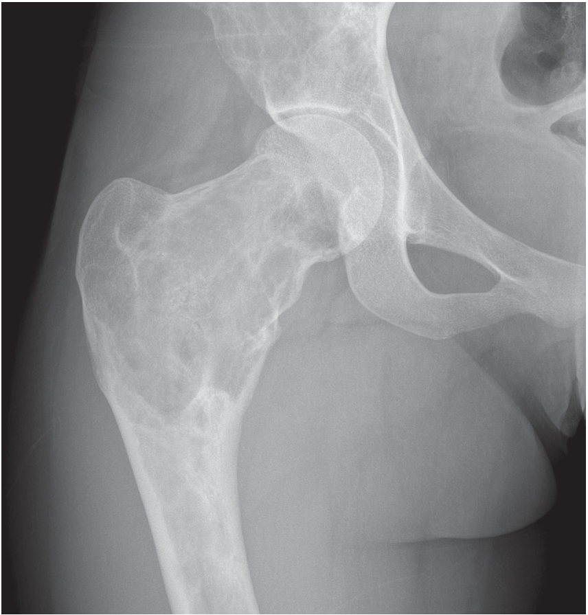 Bone Tumors of Childhood: Benign or Malignant? | Consultant360