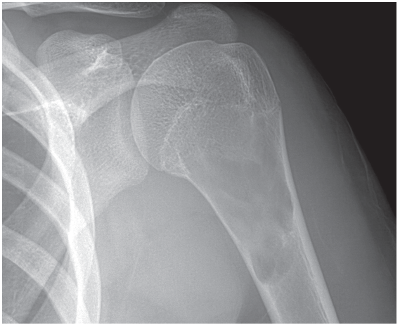 Bone Tumors of Childhood: Benign or Malignant? | Consultant360