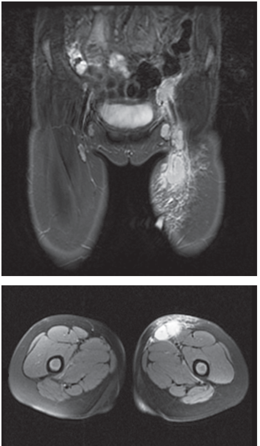Cat-Scratch Disease Presenting as Thrombocytopenia and Lymphadenopathy ...