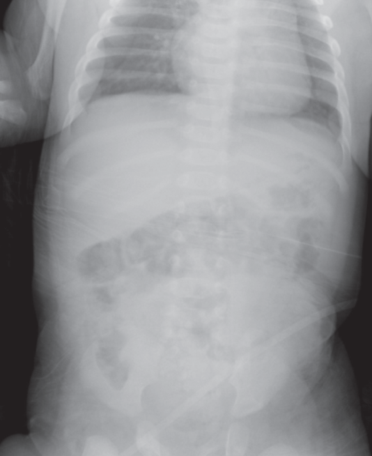 Infant With Emesis and Stomach Full of Formula | Consultant360