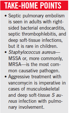 Septic Pulmonary Emboli: A Rare Complication of Community-Acquired ...