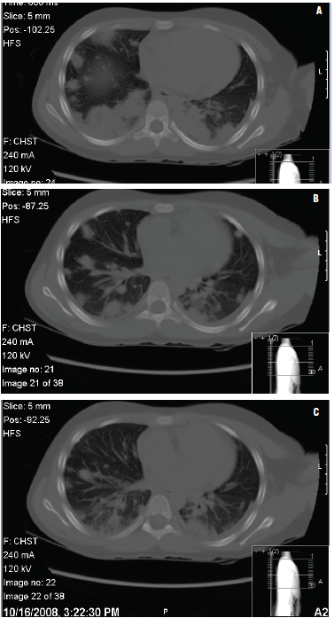 Septic Pulmonary Emboli: A Rare Complication of Community-Acquired ...