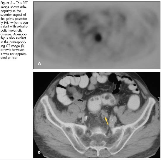 Man With Recently Diagnosed Colon Cancer | Consultant360