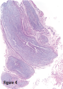 A Girl With Cerebriform Palmar Plaques | Consultant360